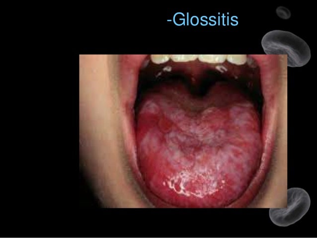 IRON DEFICIENCY ANAEMIA