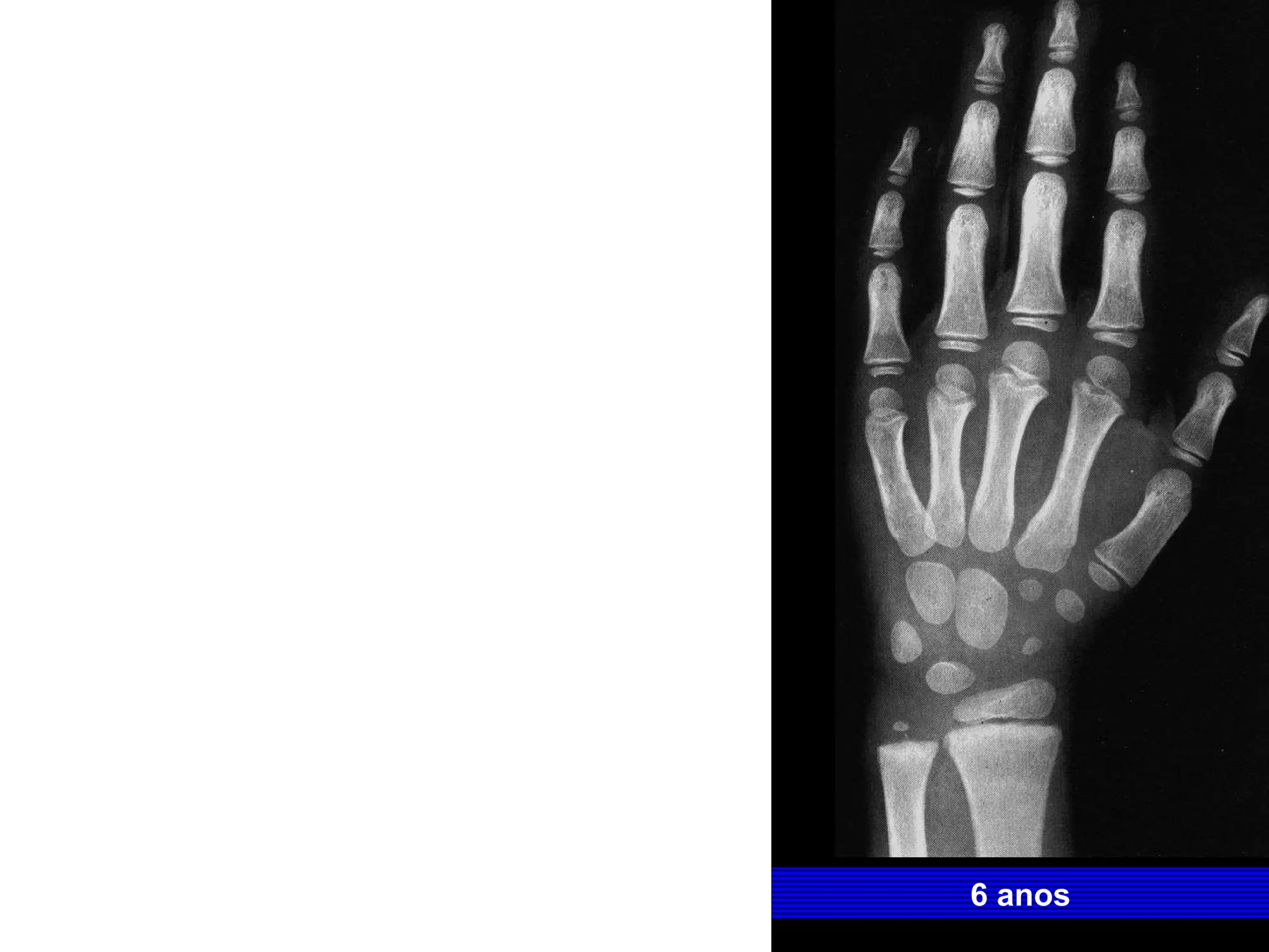 Idade ossea | PPS | Bone and Joint Conditions | Diseases and Conditions