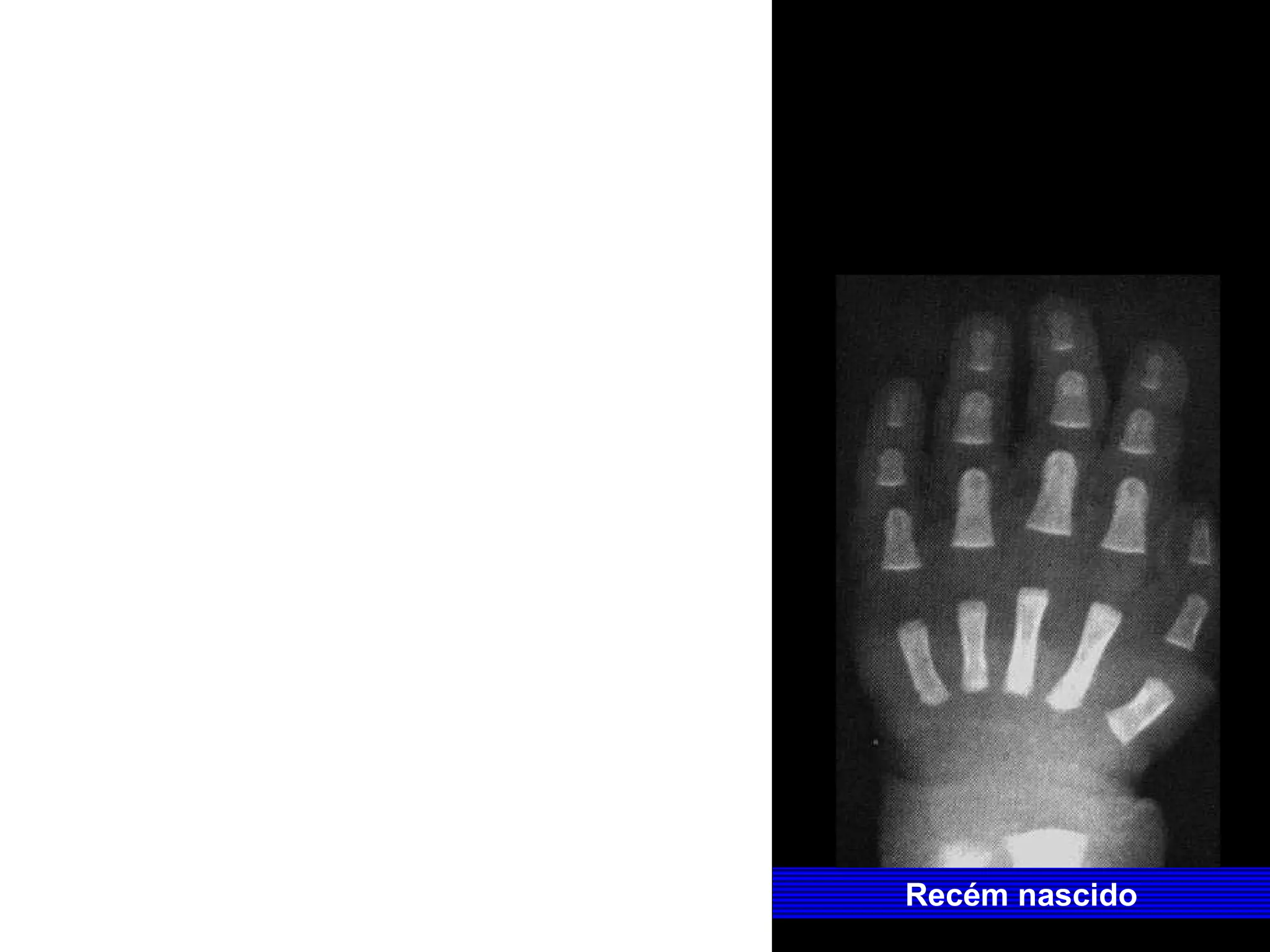 Idade ossea | PPS | Bone and Joint Conditions | Diseases and Conditions
