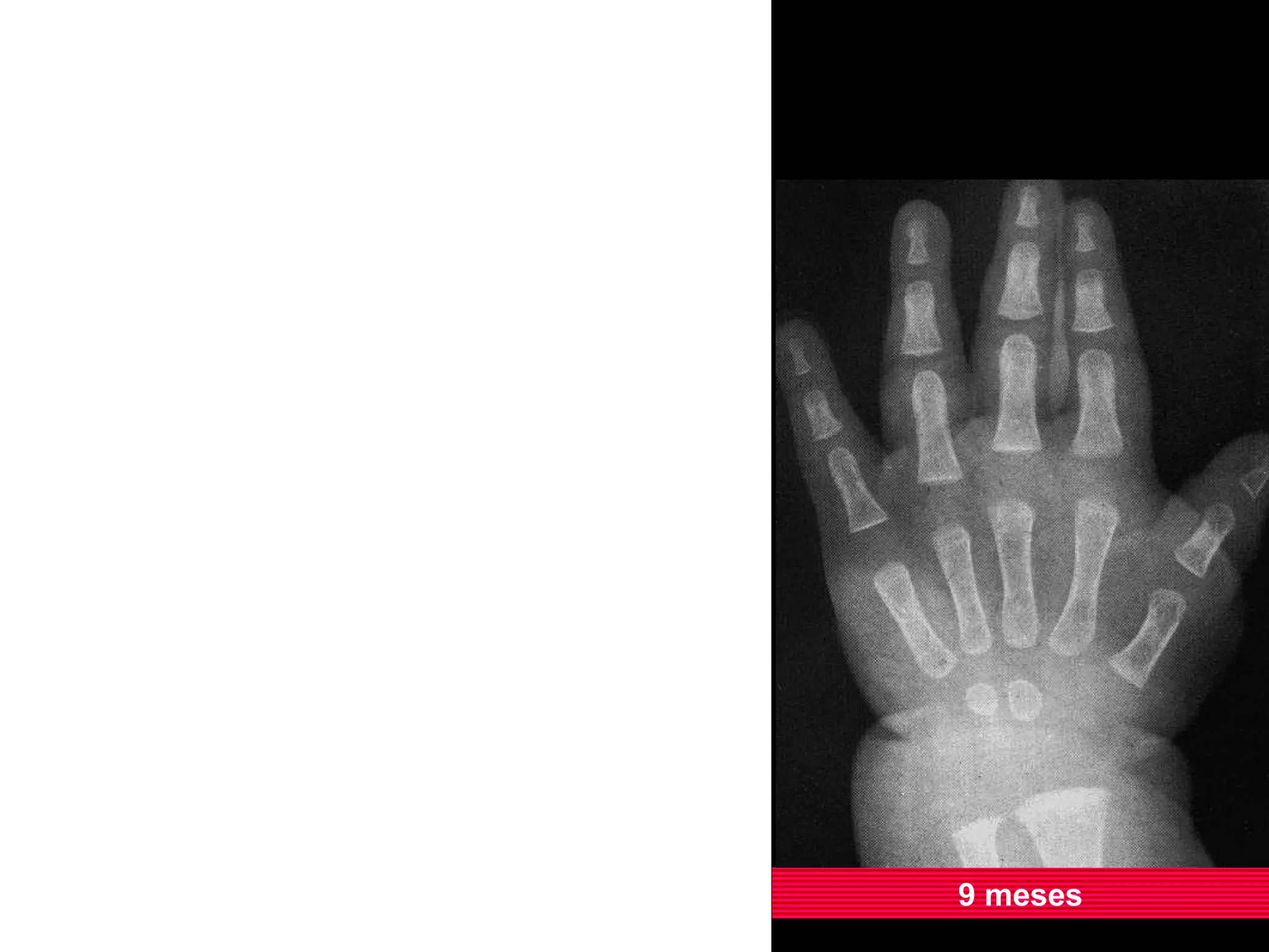 Idade ossea | PPS | Bone and Joint Conditions | Diseases and Conditions