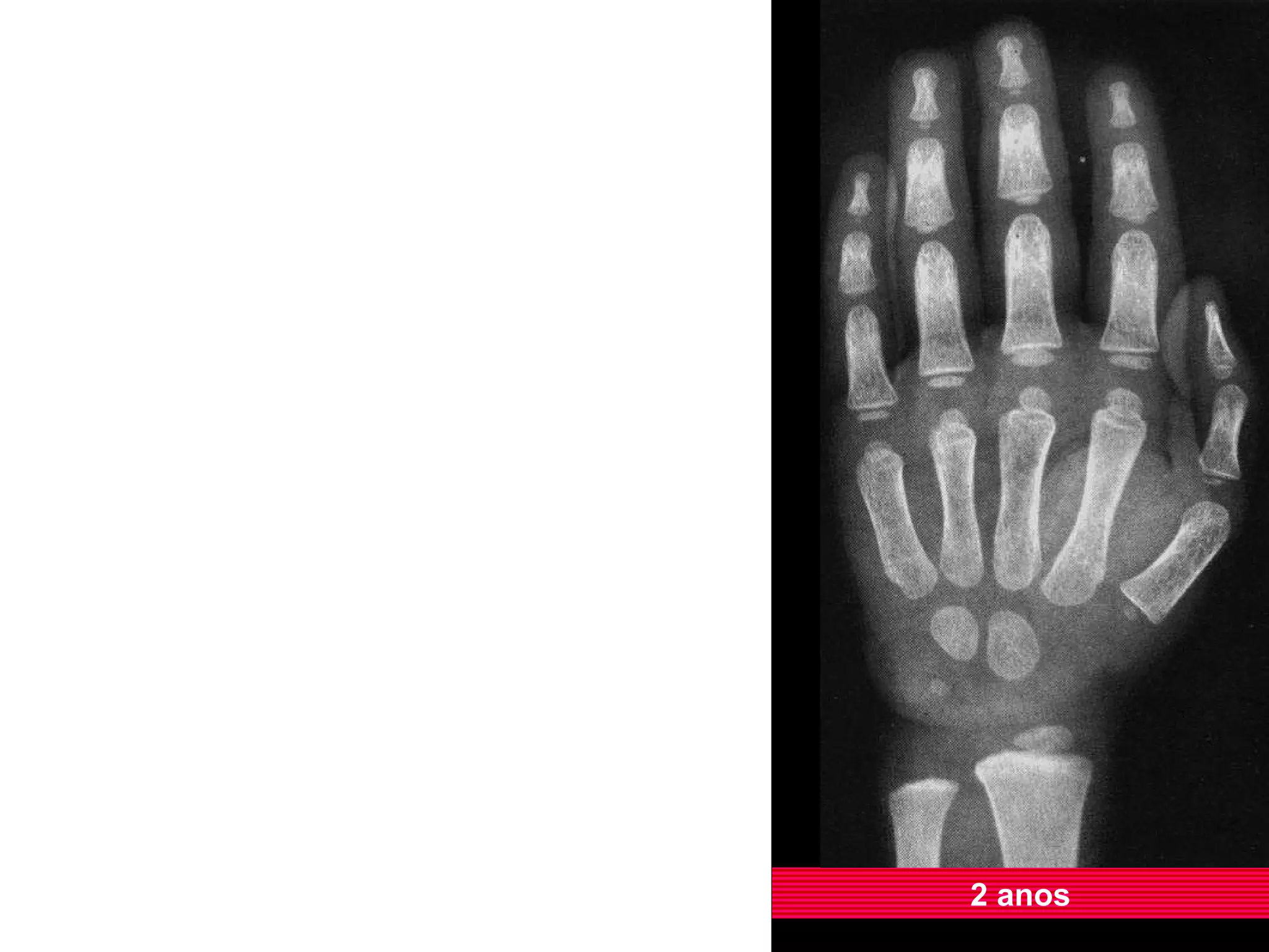 Idade ossea | PPS | Bone and Joint Conditions | Diseases and Conditions
