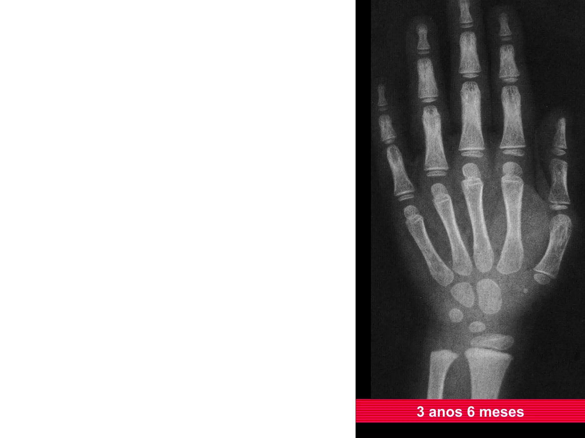Idade ossea | PPS | Bone and Joint Conditions | Diseases and Conditions