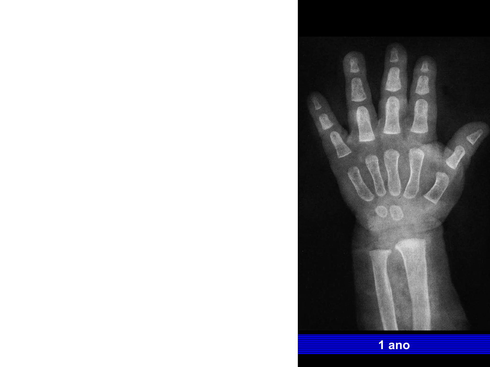 Idade ossea | PPS | Bone and Joint Conditions | Diseases and Conditions
