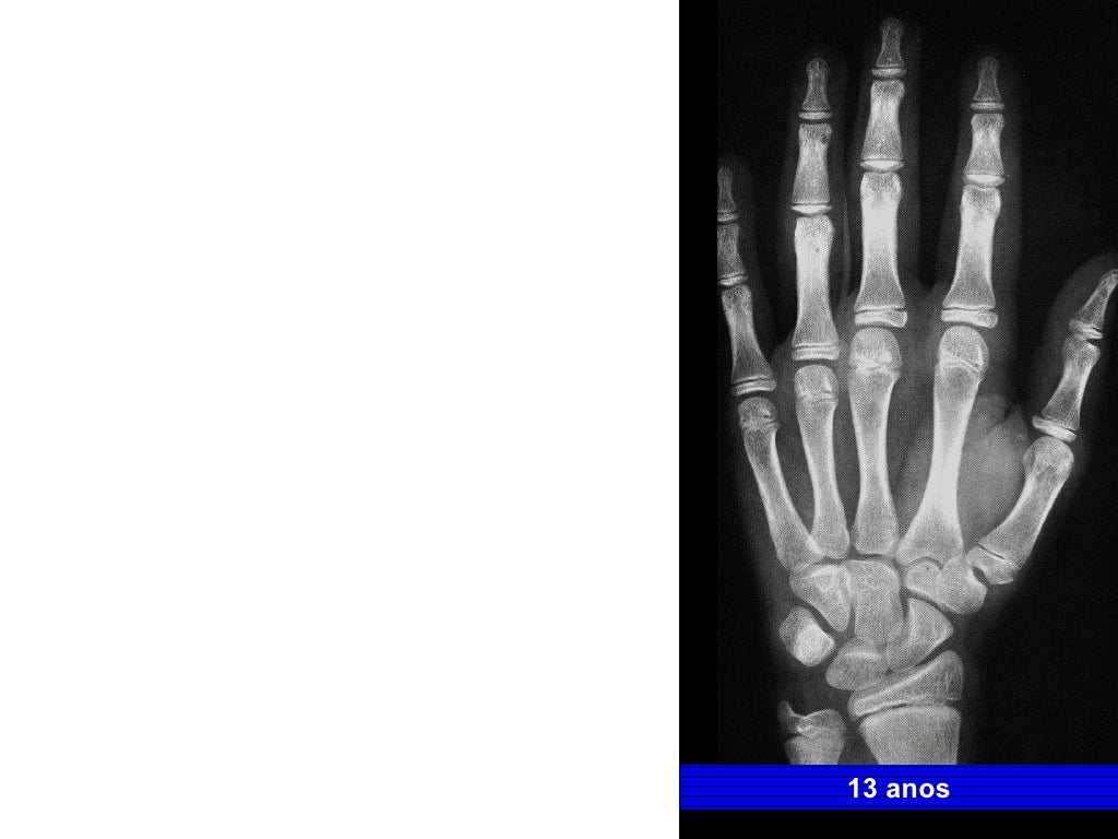 Tabela Idade óssea Greulich & Pyle - RETOEDU