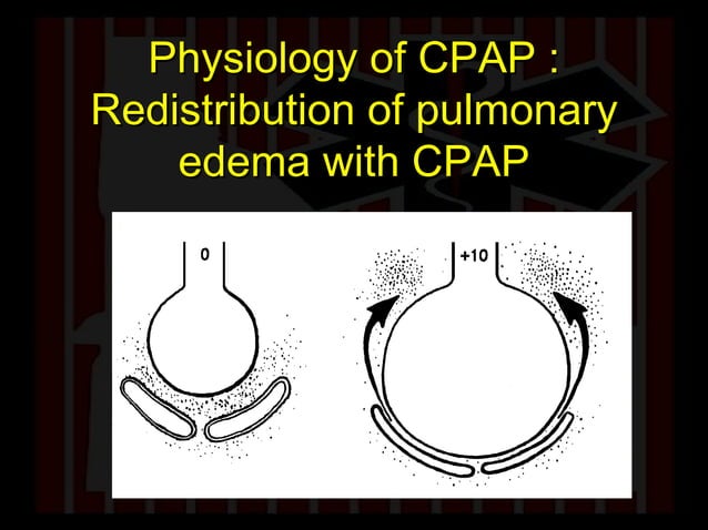 EMS CPAP Training | PPT | Lung and Respiratory Health | Diseases and ...