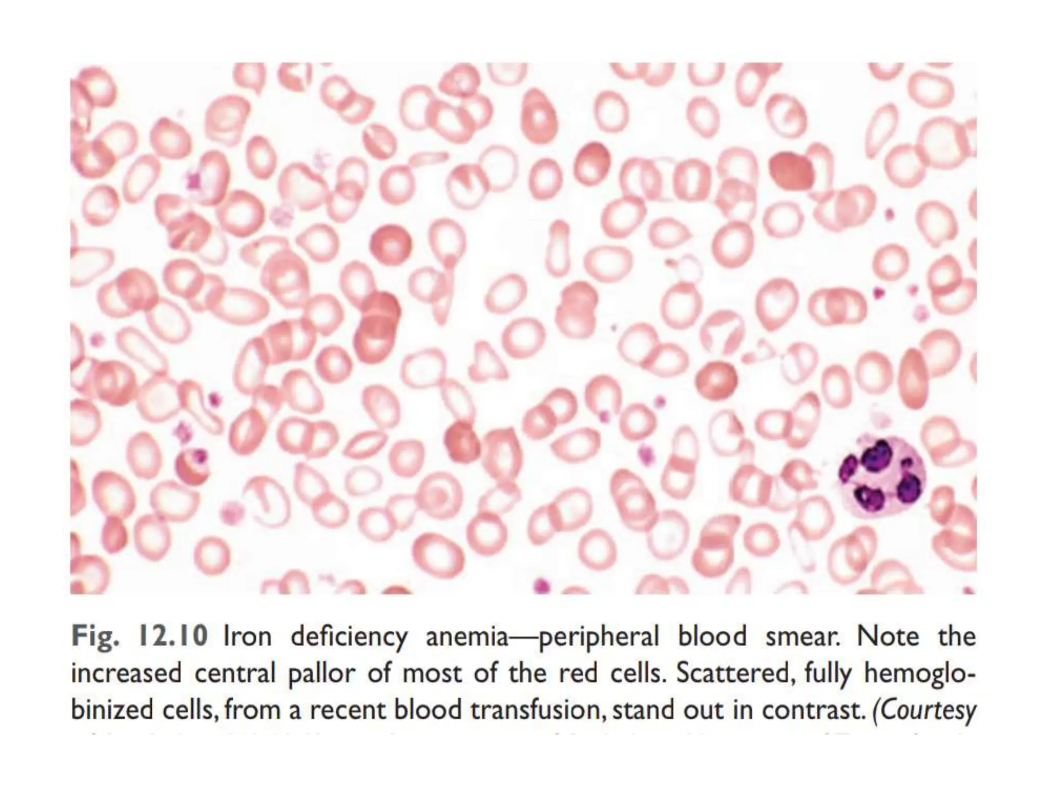 Iron deficiency anemia in pregnancy.pptx