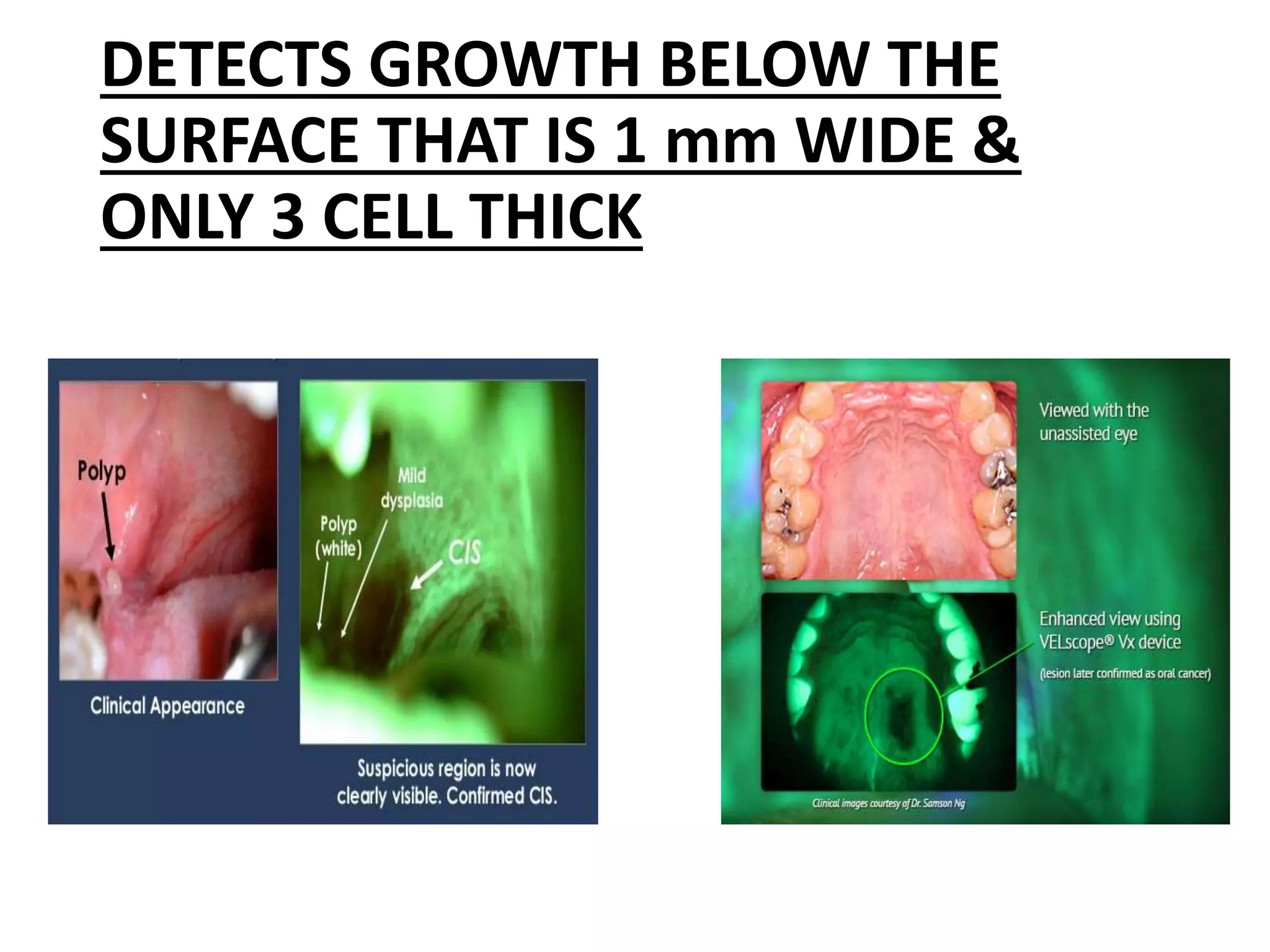 VELSCOPE: ASSESSMENT SYTEM FOR ORAL CANCER SCREENING | PPTX