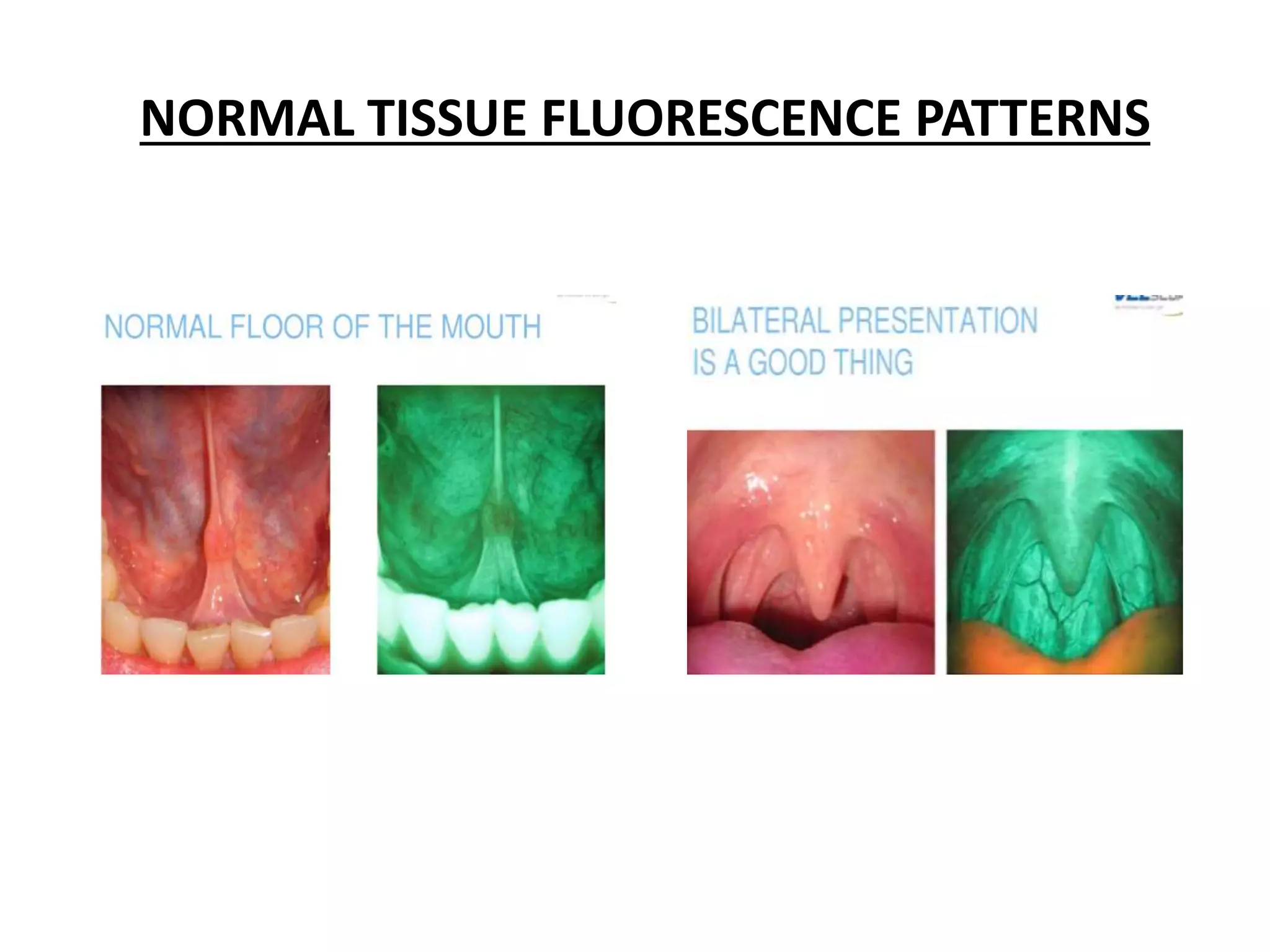 VELSCOPE: ASSESSMENT SYTEM FOR ORAL CANCER SCREENING | PPTX
