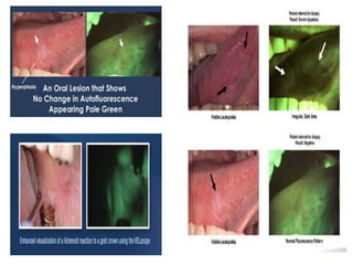 VELSCOPE: ASSESSMENT SYTEM FOR ORAL CANCER SCREENING | PPTX