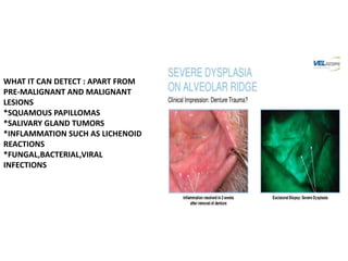 VELSCOPE: ASSESSMENT SYTEM FOR ORAL CANCER SCREENING | PPTX