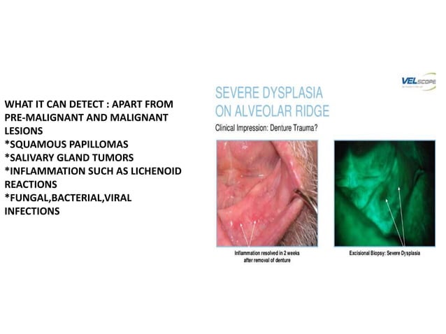 VELSCOPE: ASSESSMENT SYTEM FOR ORAL CANCER SCREENING | PPTX