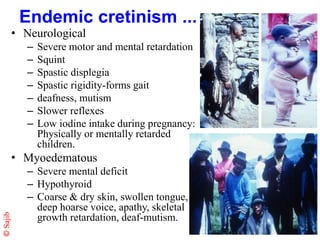 Iodine Deficiency Cretinism