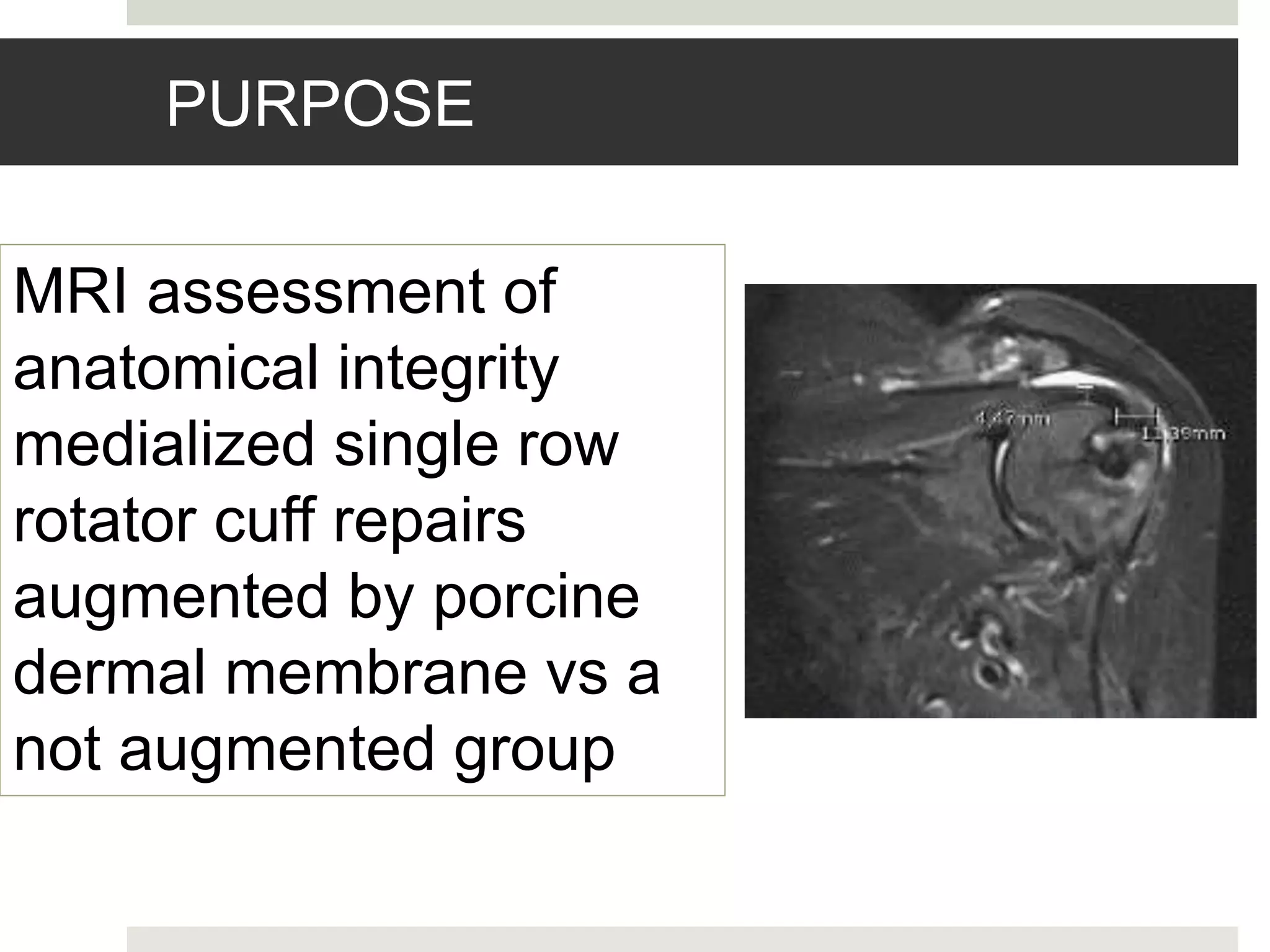 Rotator cuff augmentation with Conexa | PPTX