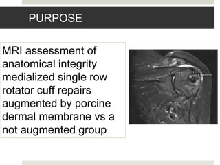 Rotator cuff augmentation with Conexa | PPTX