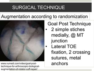 Rotator cuff augmentation with Conexa | PPTX