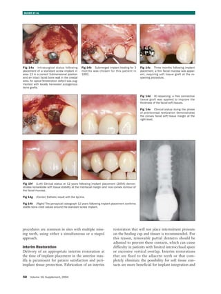Ideal implant positioning 1 | PDF