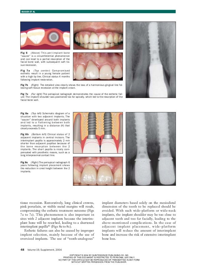 Ideal implant positioning 1