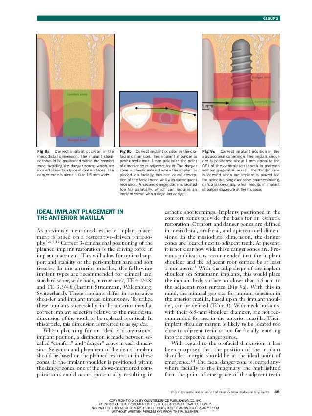 Ideal implant positioning 1