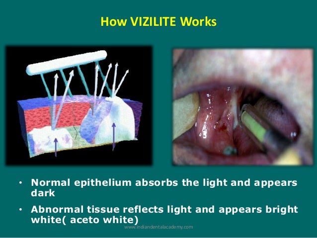 DIAGNOSTIC AIDS FOR ORAL CANCER/ dental crown & bridge courses