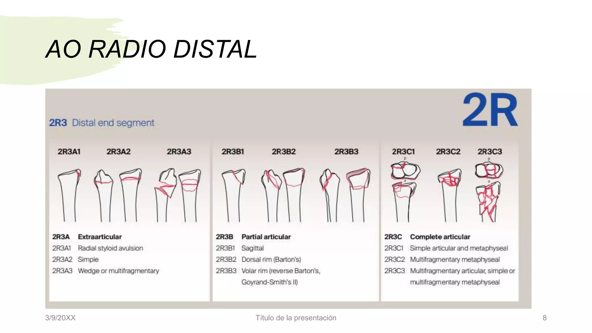 Ideas clave fracturas radio distal.pptx