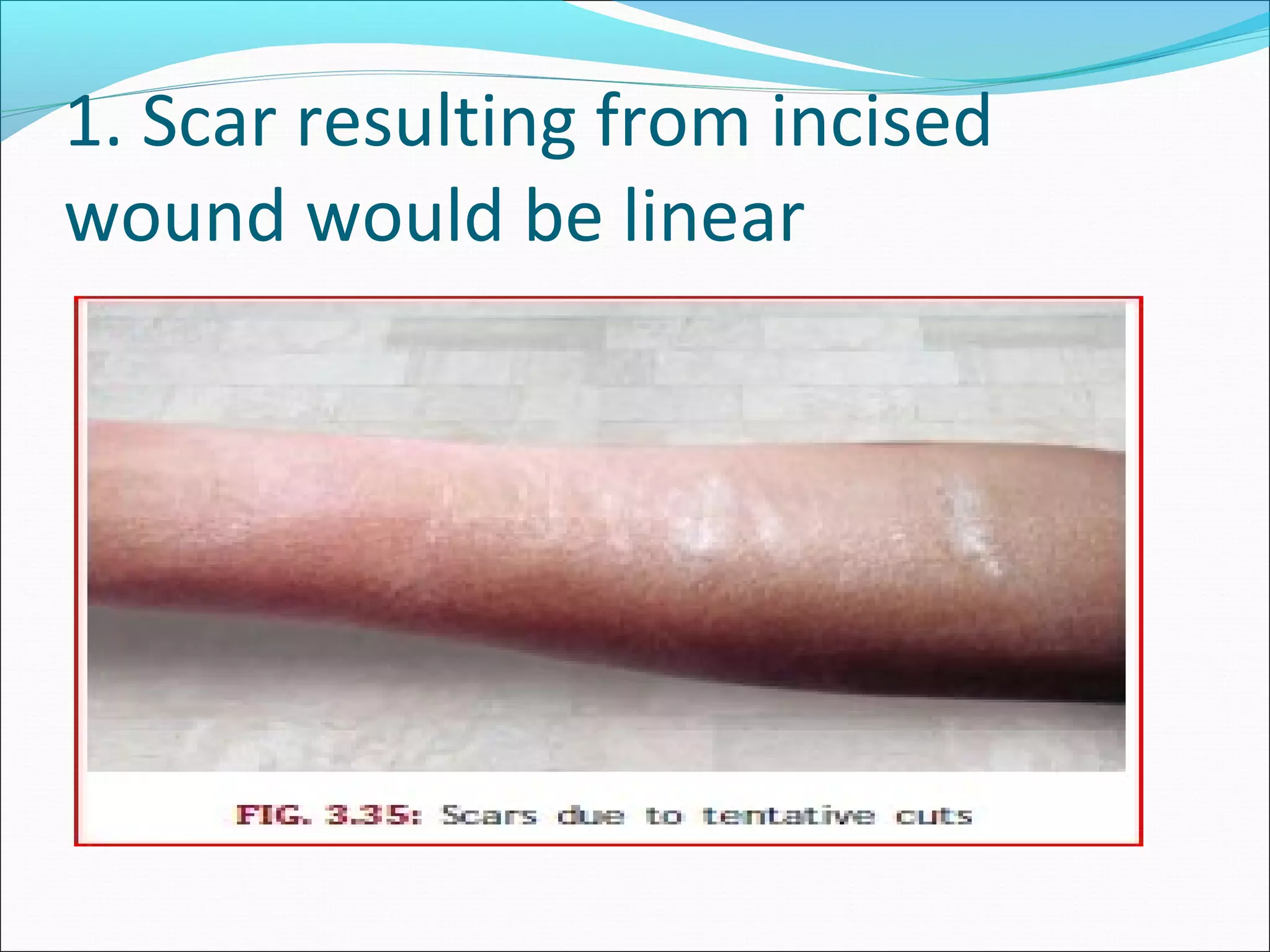 IDENTIFICATION BY SCARS, TATOO MARKS, FINGER PRINT, FOOT PRINTS , SHOE ...