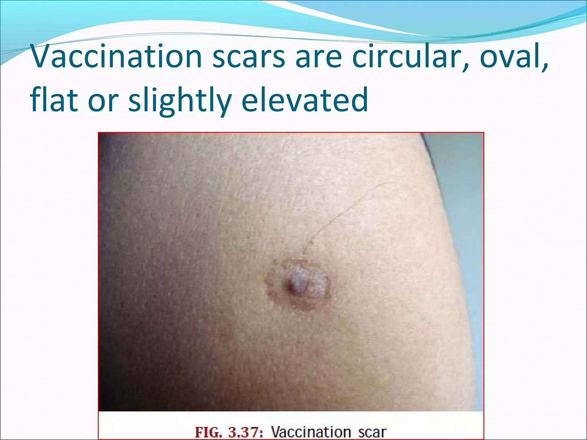 IDENTIFICATION BY SCARS, TATOO MARKS, FINGER PRINT, FOOT PRINTS , SHOE ...