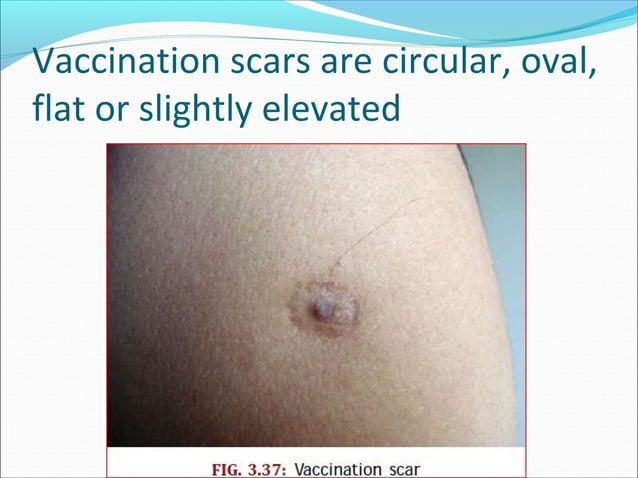 IDENTIFICATION BY SCARS, TATOO MARKS, FINGER PRINT, FOOT PRINTS , SHOE ...