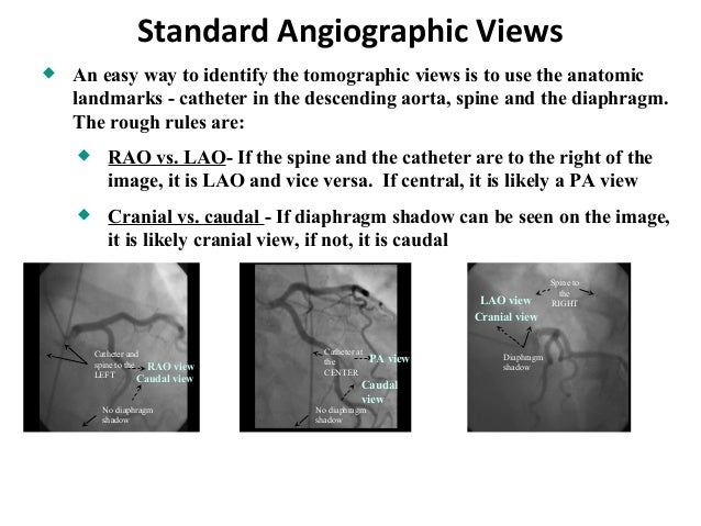 Identification of coronary arteries by different angiographic views