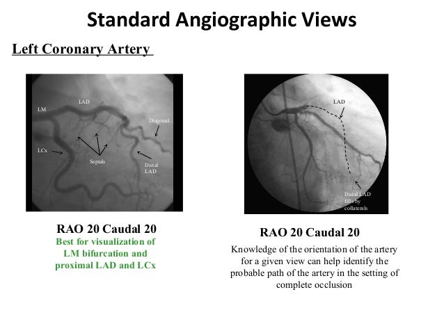 Identification of coronary arteries by different angiographic views