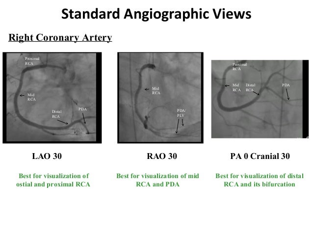 Identification of coronary arteries by different angiographic views