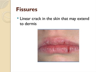 IDENTIFICATION OF LESION 1.pptx foe nursing | PPT