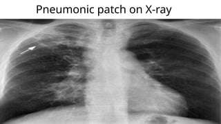 Identification of pneumonic patches.pptx | Free Download