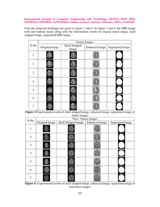 Identifying brain tumour from mri image using modified fcm and support | PDF