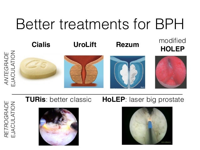 BPH treatments that safer, preserve ejaculation and help urinary symp…