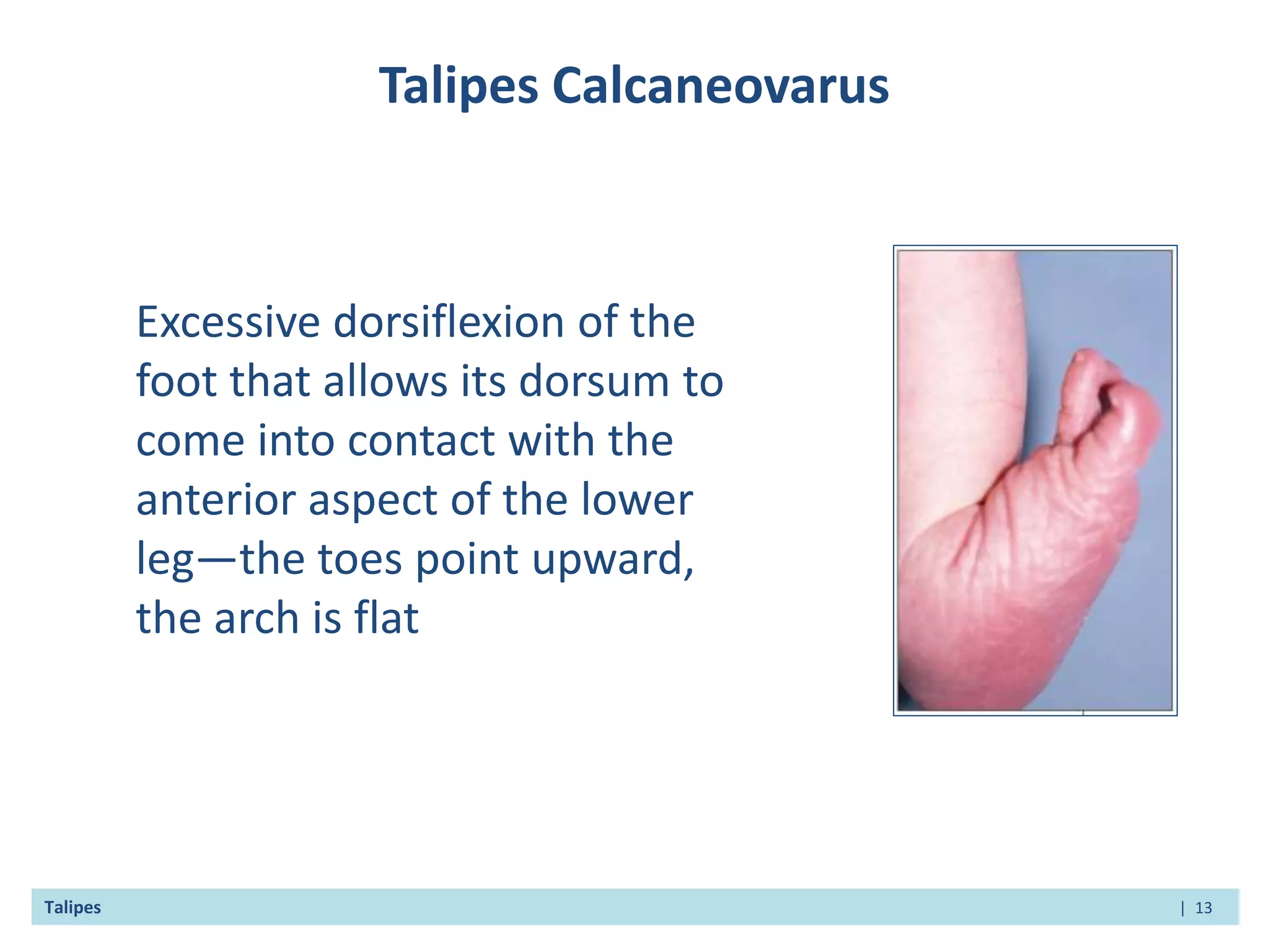 Idiopathic-Talipes-Equinovarus-Congenital-Clubfoot.pptx