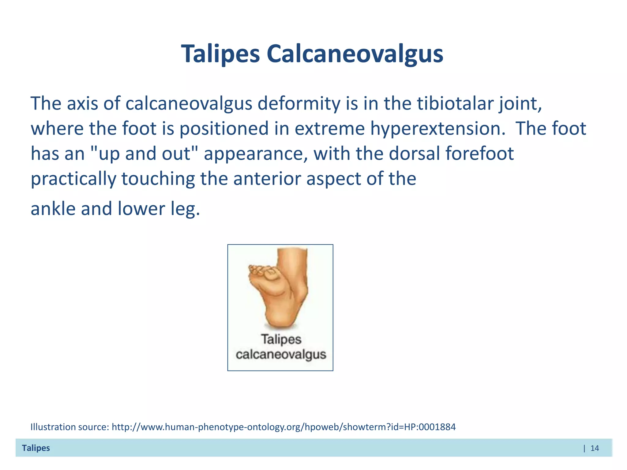 Idiopathic-Talipes-Equinovarus-Congenital-Clubfoot.pptx