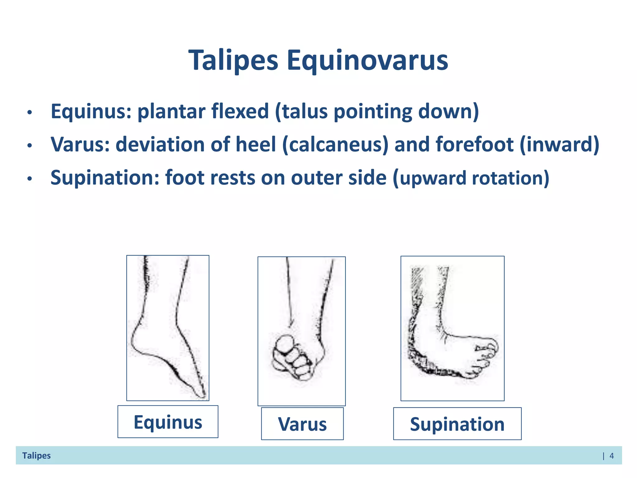 Idiopathic-Talipes-Equinovarus-Congenital-Clubfoot.pptx