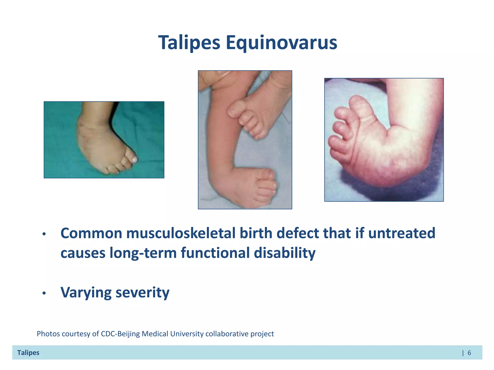 Idiopathic-Talipes-Equinovarus-Congenital-Clubfoot.pptx