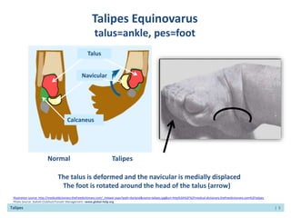 Idiopathic-Talipes-Equinovarus-Congenital-Clubfoot.pptx | Death, Injury ...