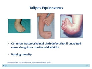 Idiopathic-Talipes-Equinovarus-Congenital-Clubfoot.pptx