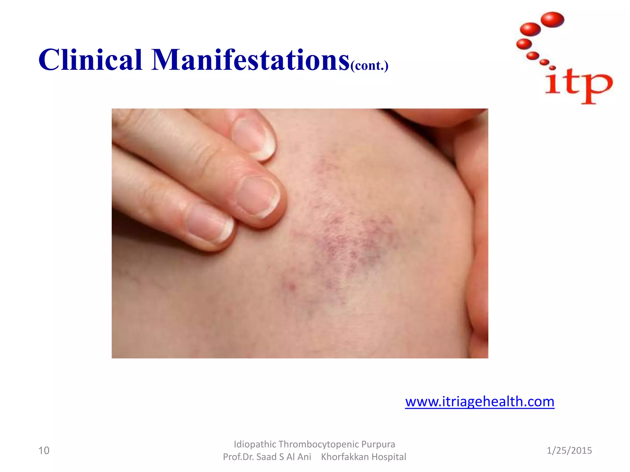 Idiopathic (autoimmune) Thrombocytopenic Purpura | PPTX