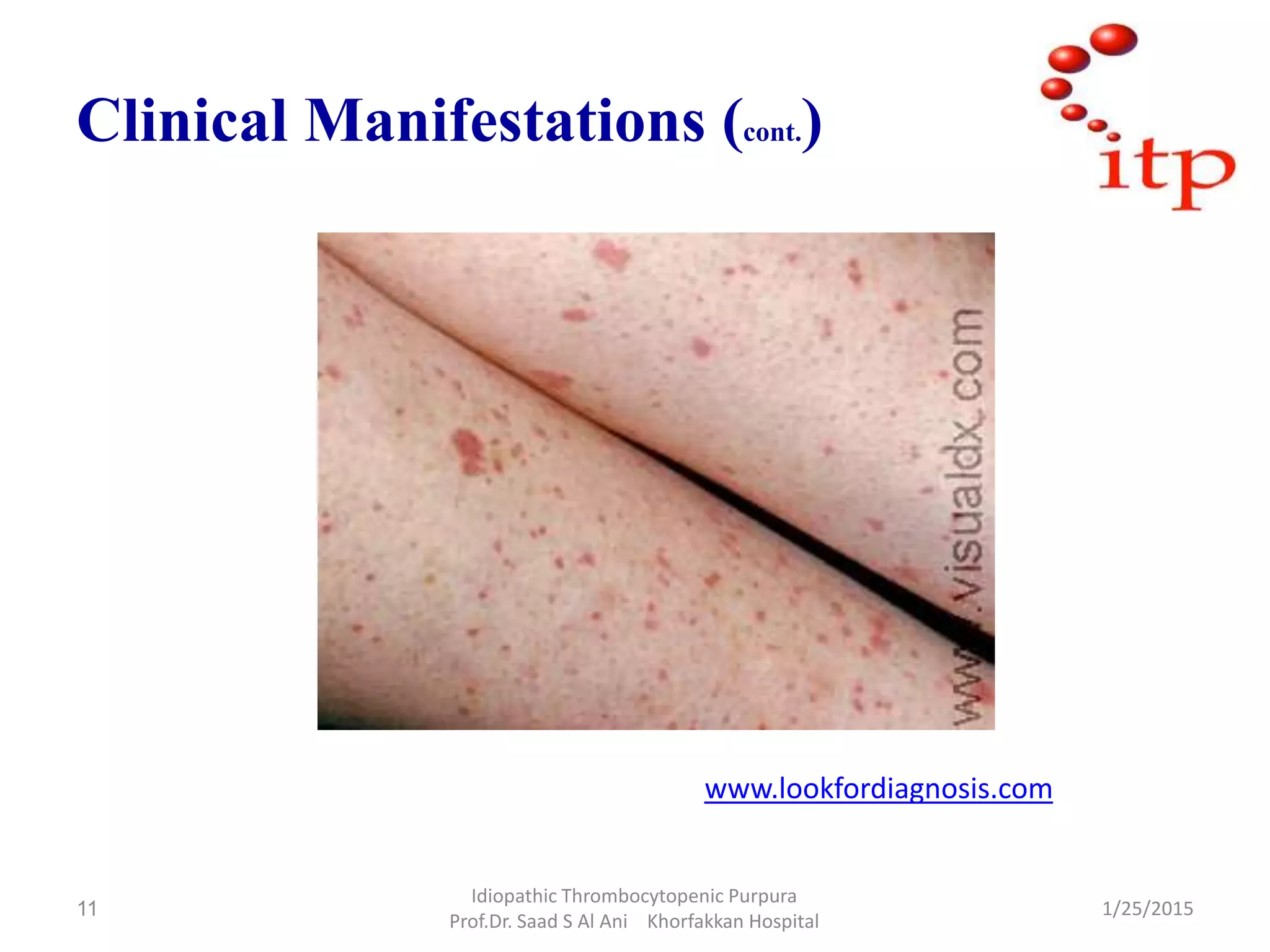 Idiopathic (autoimmune) Thrombocytopenic Purpura | PPTX