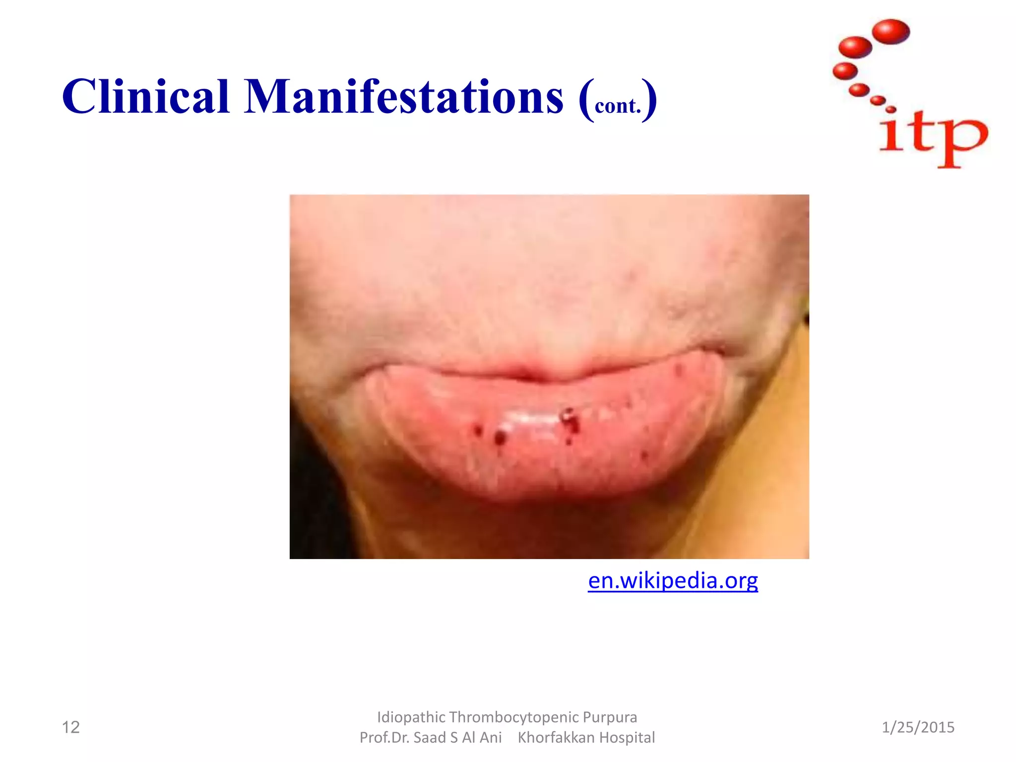 Idiopathic (autoimmune) Thrombocytopenic Purpura | PPTX