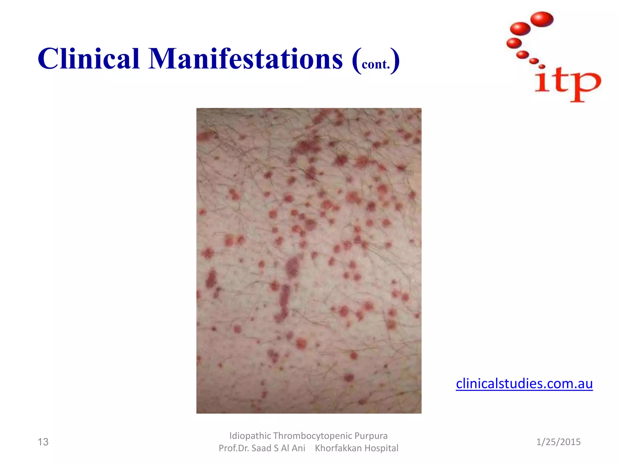 Idiopathic (autoimmune) Thrombocytopenic Purpura | PPTX