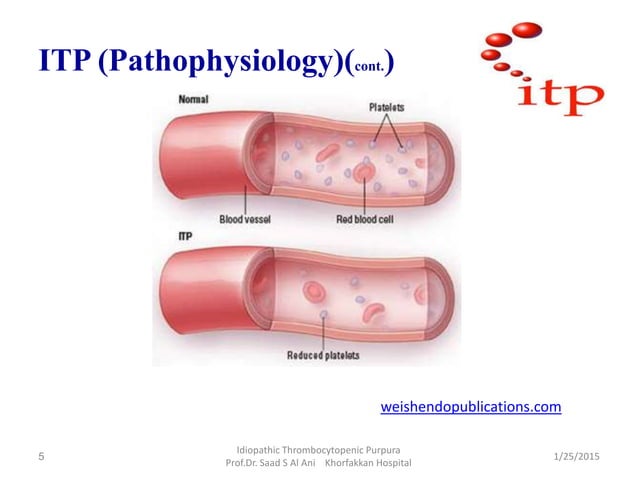 Idiopathic (autoimmune) Thrombocytopenic Purpura | PPTX