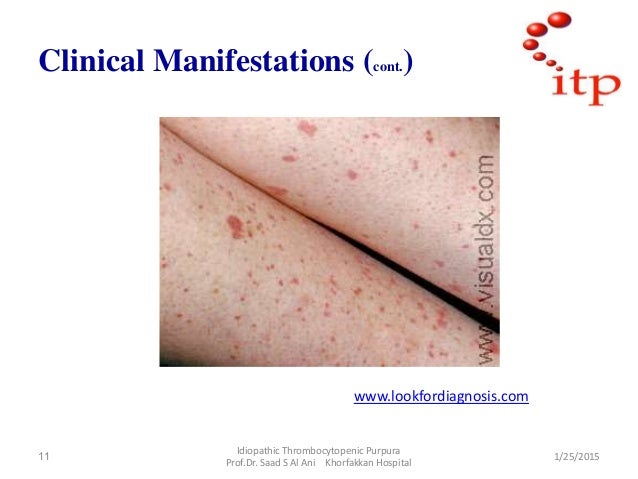 Idiopathic (autoimmune) Thrombocytopenic Purpura