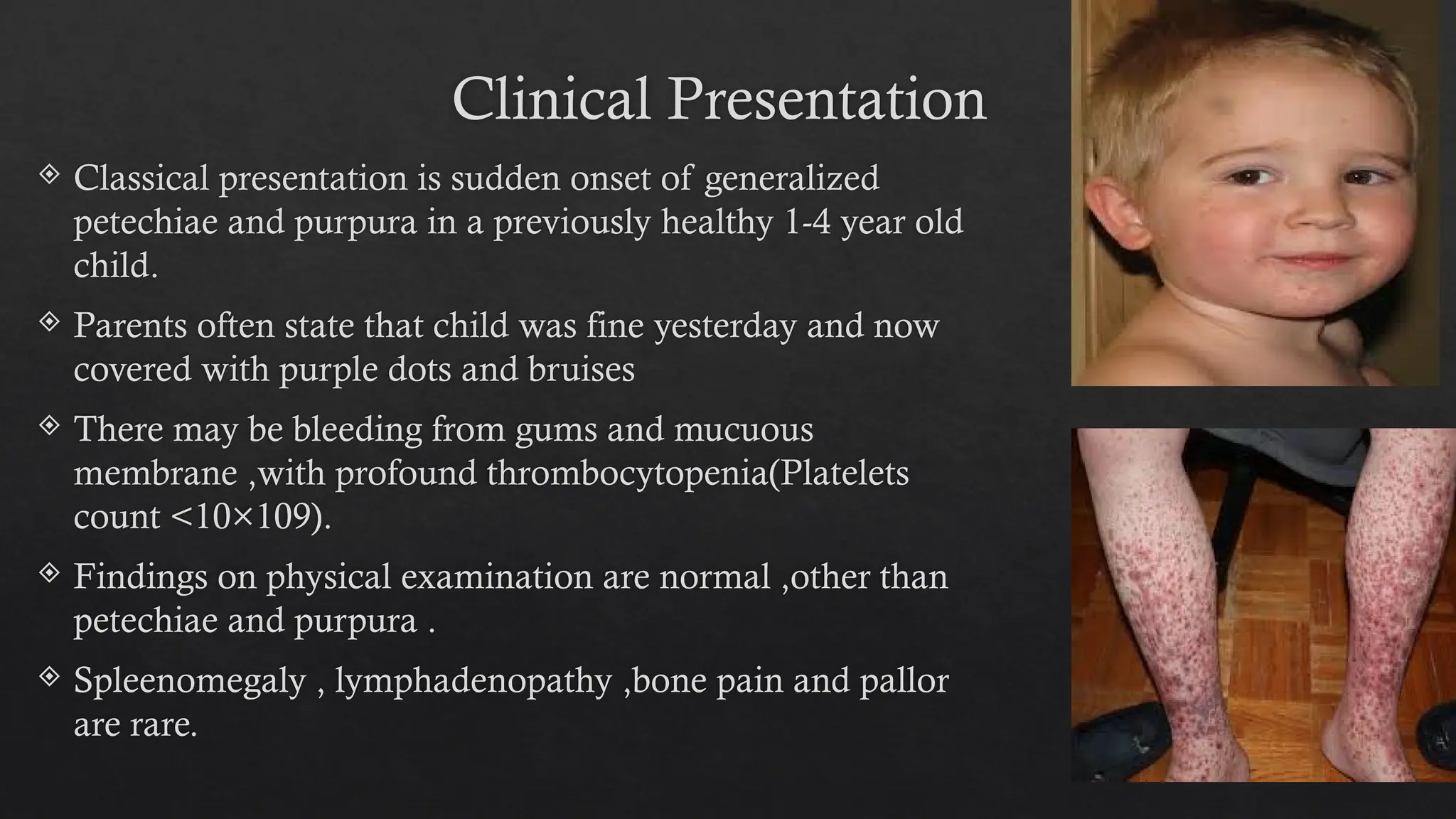 Immune thrombocytopenic purpura(ITP) .pptx