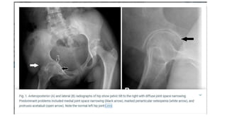 Idiopathic chondrolysis of hip | PPTX | Bone and Joint Conditions ...