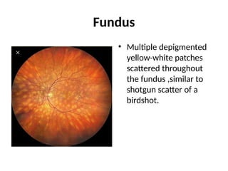 IDIOPATHIC CHORIORETINOPATHIES. PRESENTATION | PPTX