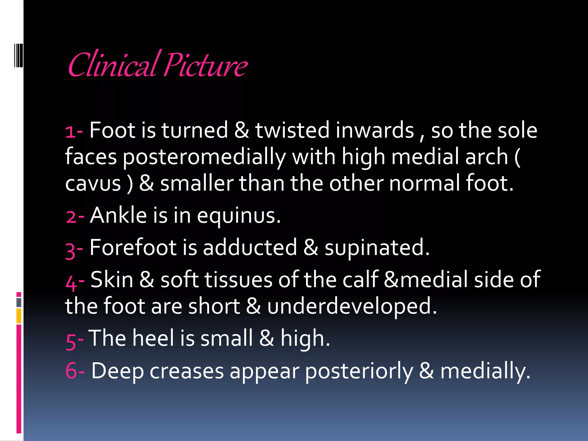 Idiopathic club foot | PPTX